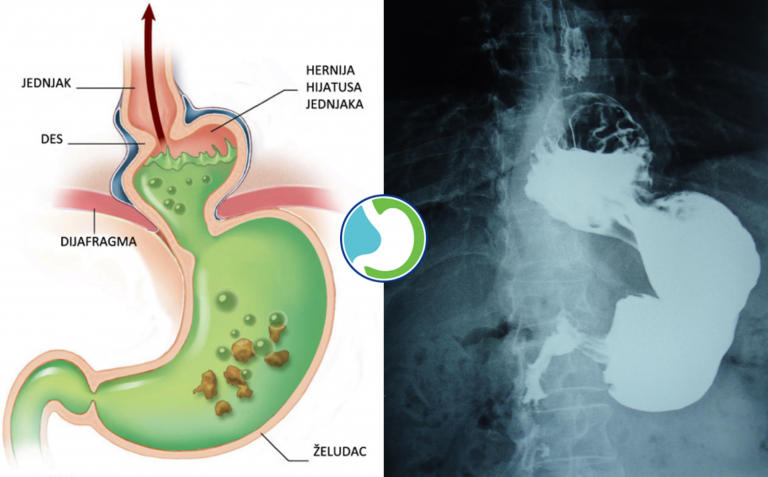 Gorušica - Simptomi, uzroci i komplikacije