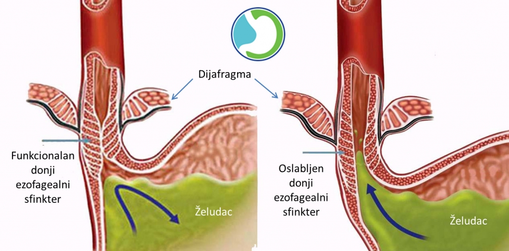 Gastroezofagealna refluksna bolest - GERB - Simptomi i uzroci