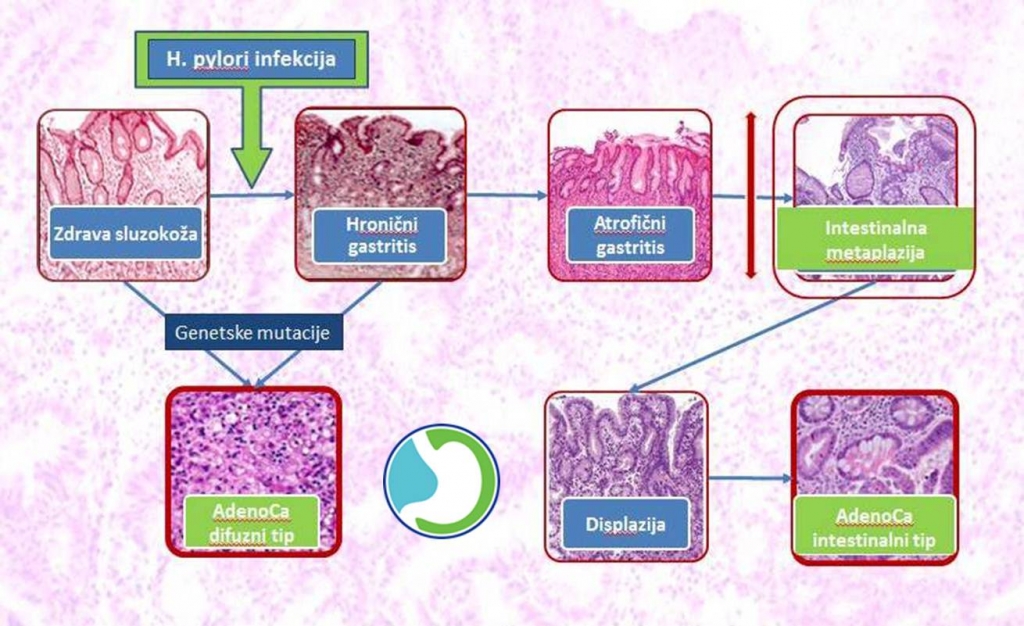 Gastritis - Šta je gastritis? - Erozivni i neerozivni - RefluxCentar